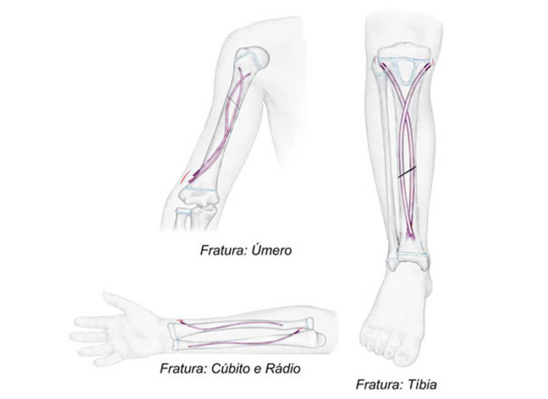 Haste Intramedular Ponta Diamante (Fio Guia) - Tíbia - Titanium Produtos